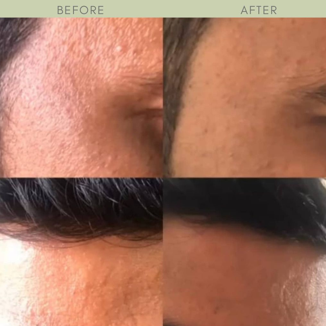 PORE CORRECTOR (Blackhead And Whitehead Solution) – Ornella